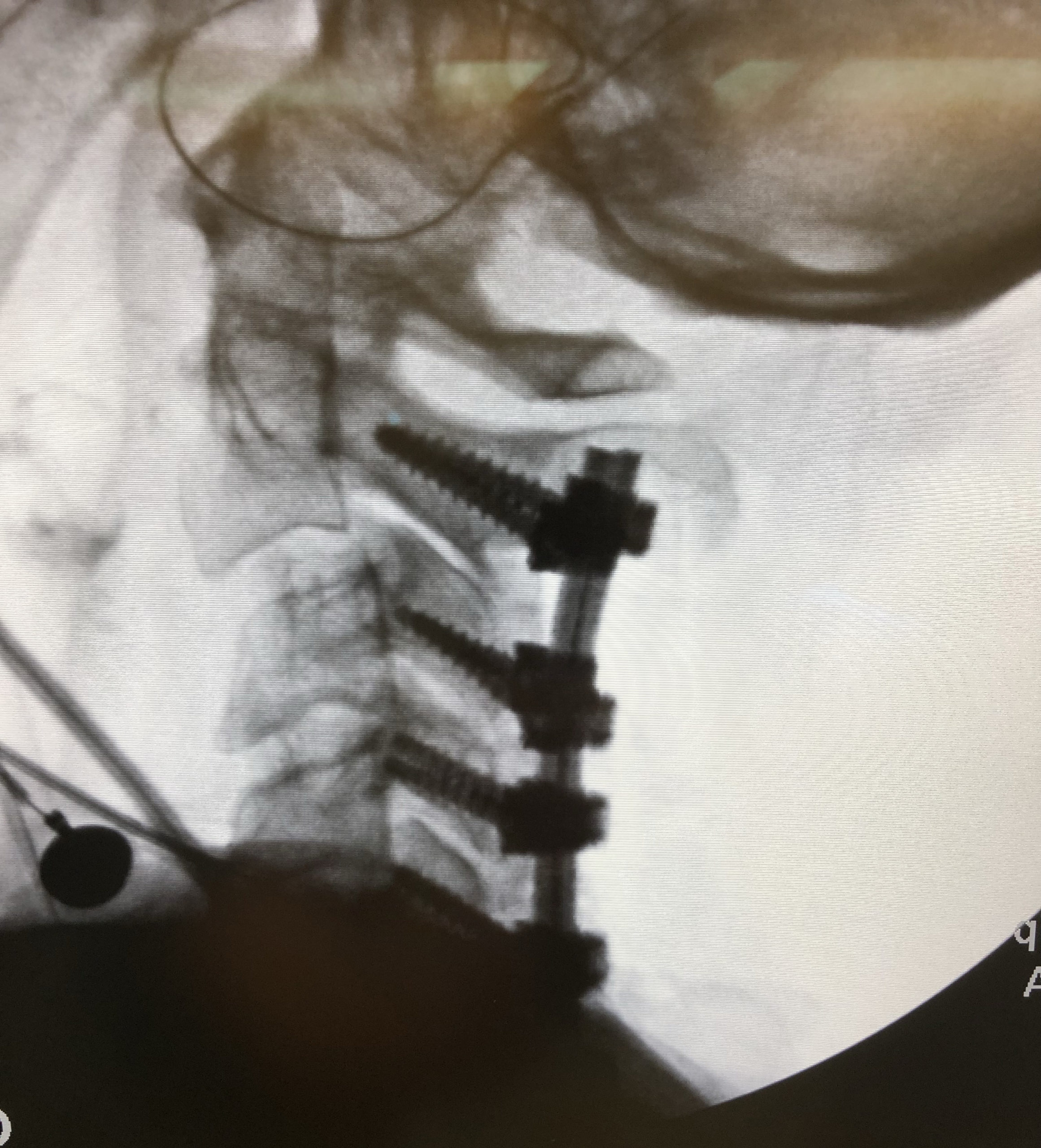 PCF - ATEC Spine