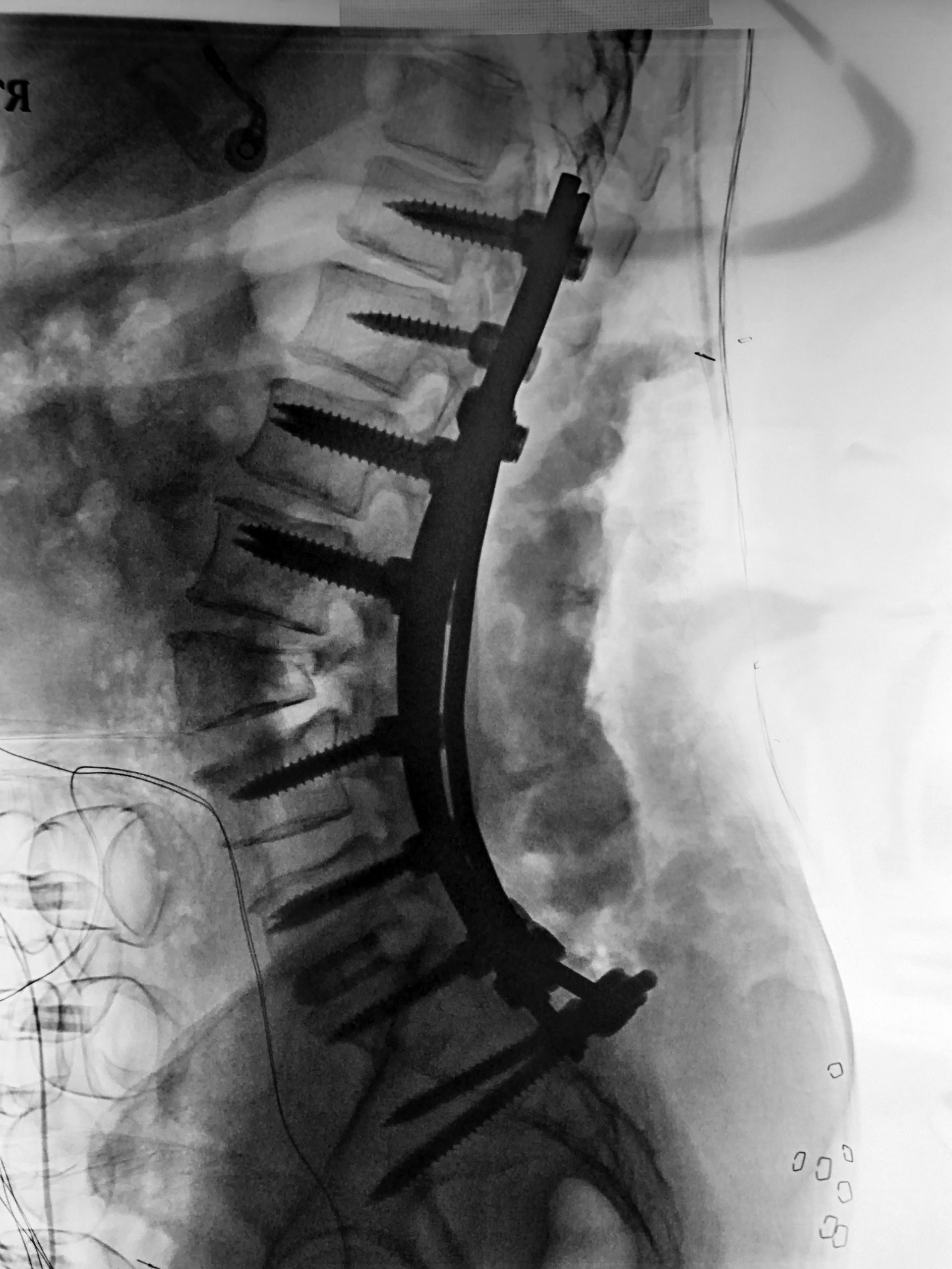 PF - ATEC Spine - Posterior Fixation