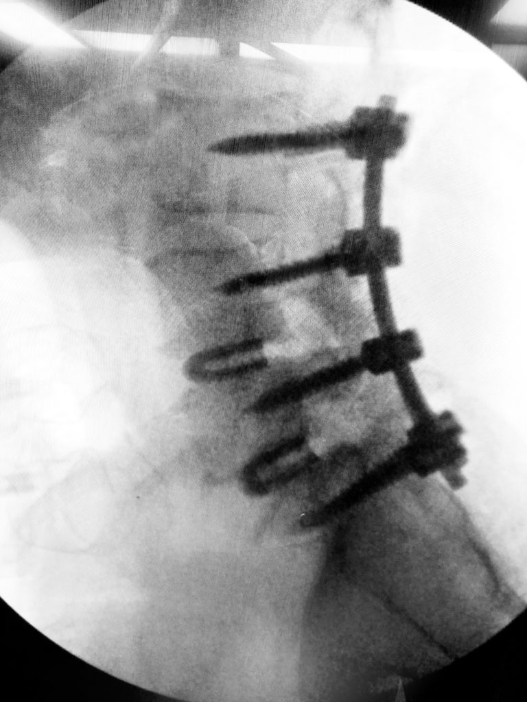 PLIF - ATEC Spine