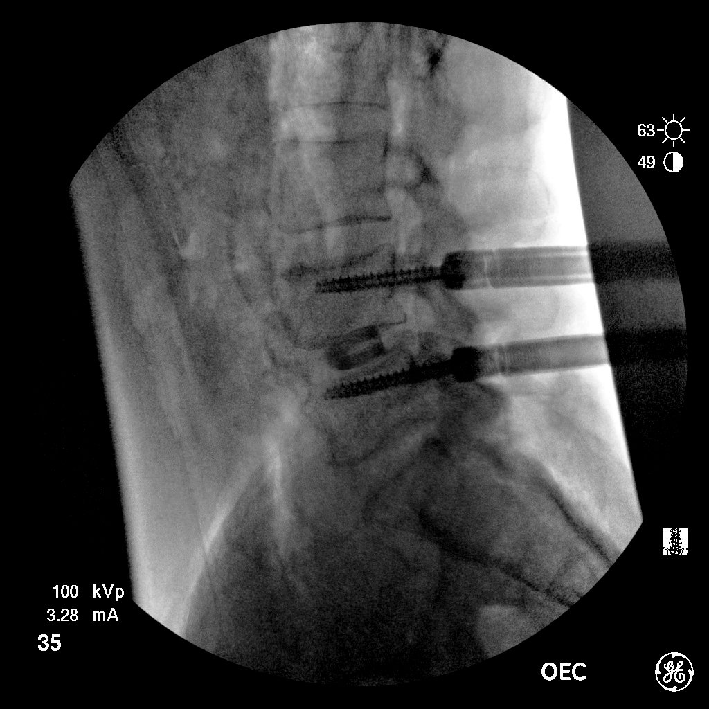 Invictus™ MIS Modular - ATEC Spine