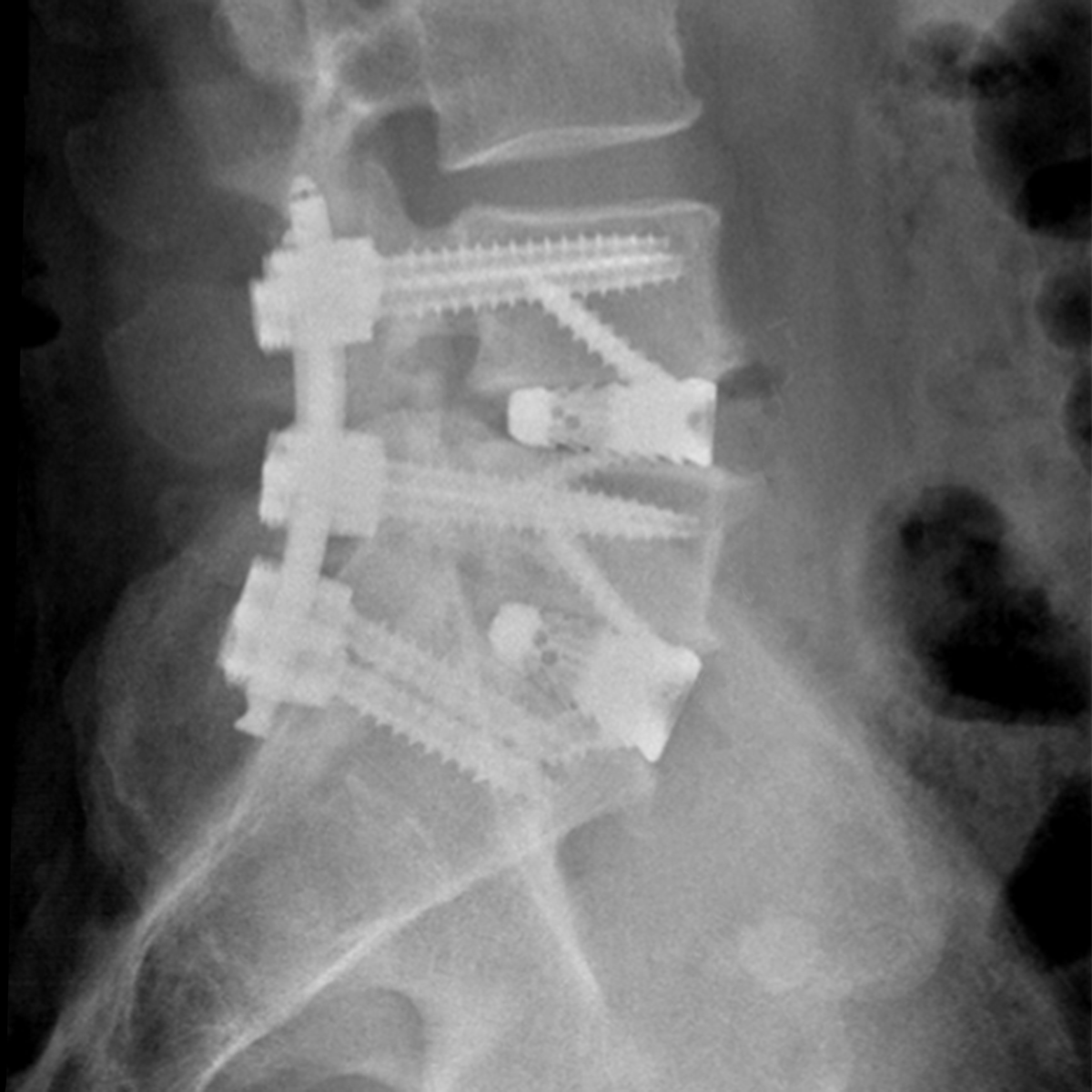 IdentiTi-ALIF Standalone - ATEC Spine