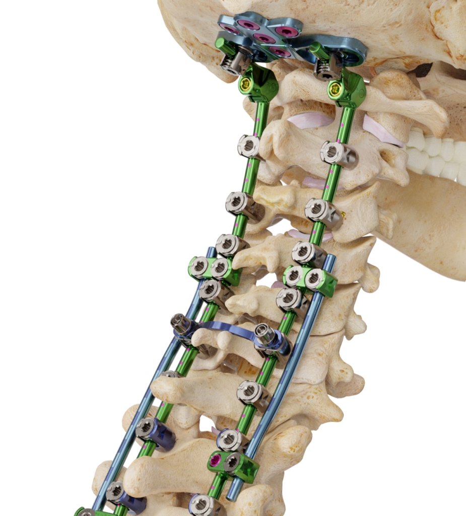 PCF - ATEC Spine
