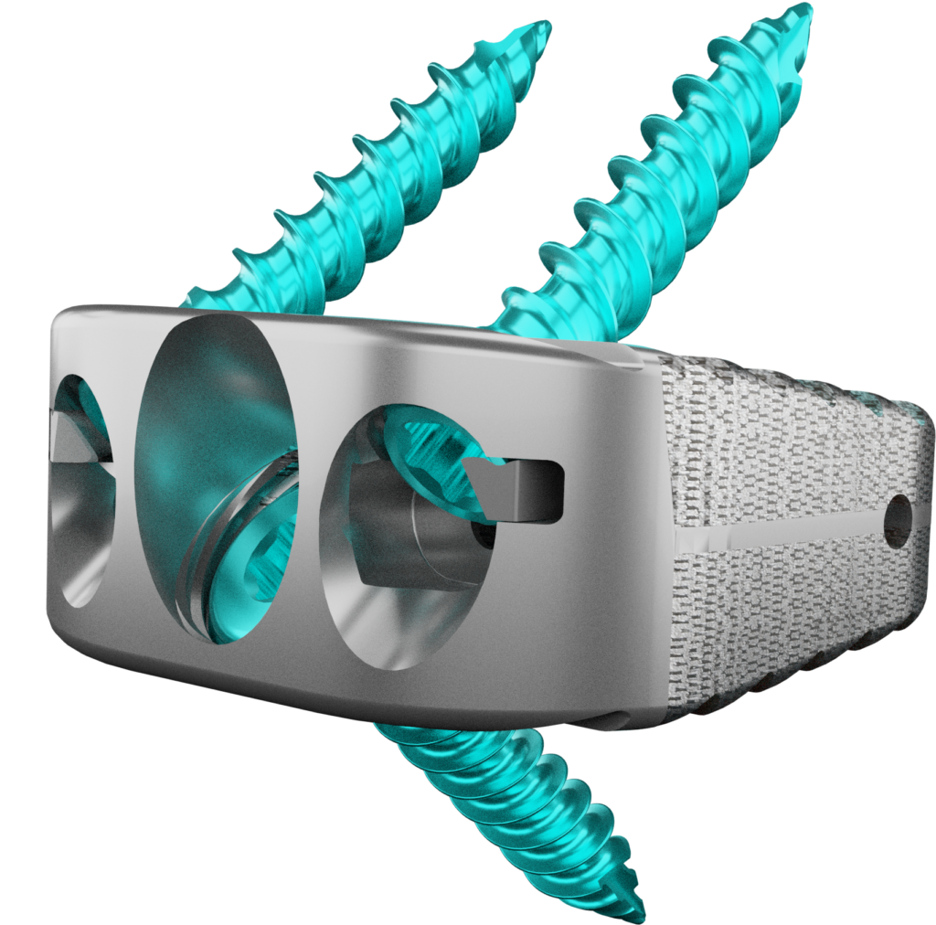 Anterior Lumbar Interbody Fusion (ALIF) - ATEC Spine